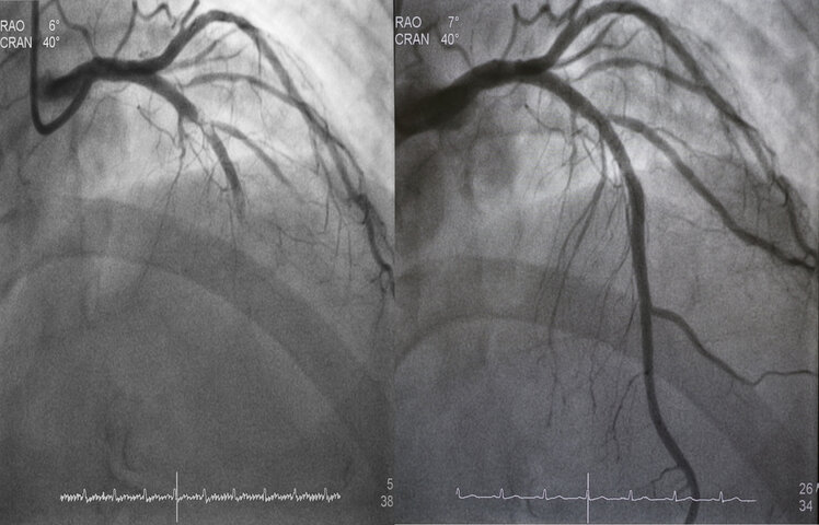 Τι Προσέχω Μετά το Στεντ ( Stent); | Καρδιολόγος Αθήνα Κέντρο - Dr ...